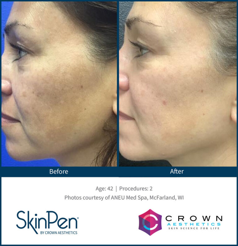 SkinPen Precision® Microneedling Guide — Cosmetic Clinic by Juicy Face